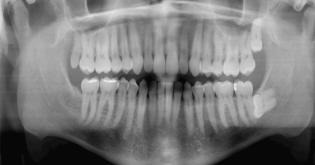 How Common Are Oral Cysts? | South Jersey oral surgeons